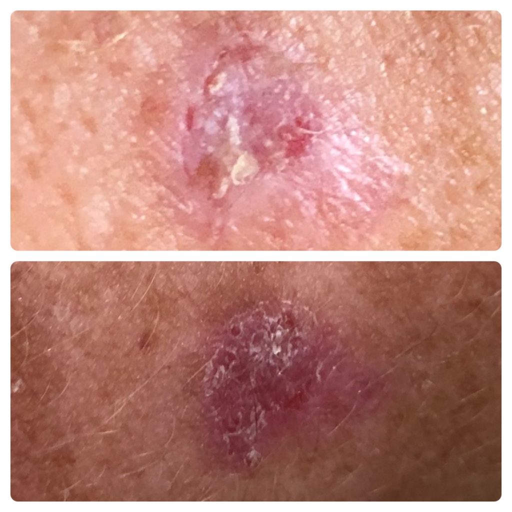 Skin Ulcer That Won t Heal Phancore Wellness Skin Ulcer That Won t Heal Phancore Wellness